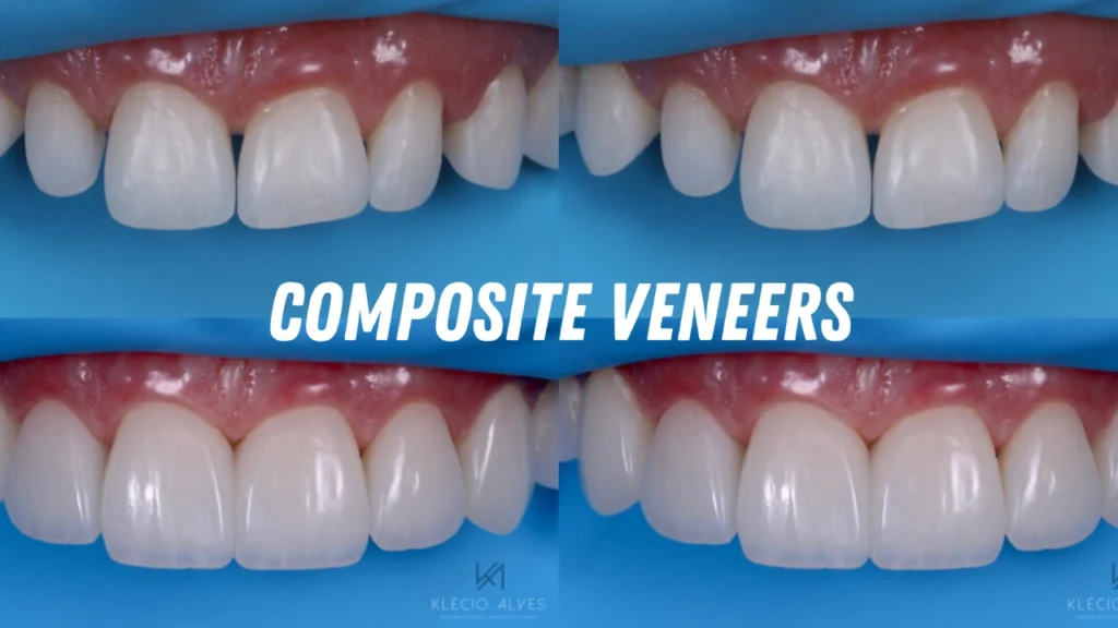 What is Composite Veneers? Cost, Procdure, Pros - Dr. Reach Dental Clinic